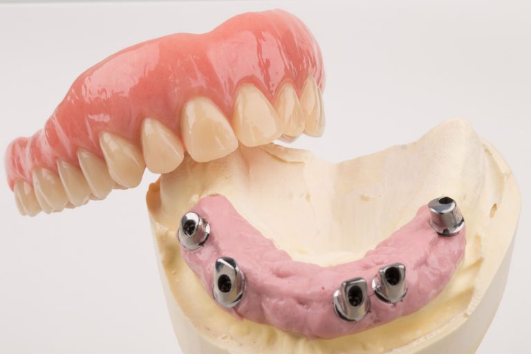 Teleskopkronen in der Front - Teleskoparbeit