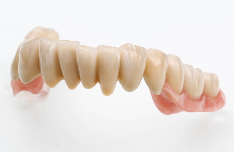 Teleskopkronen in der Front - Teleskoparbeit